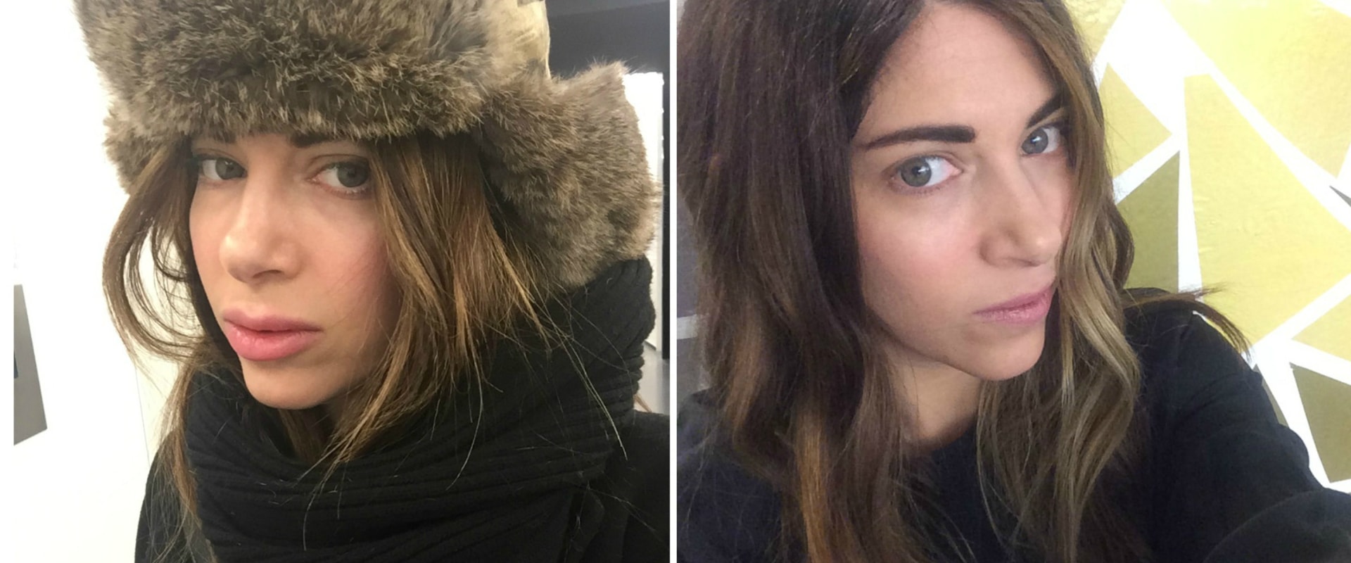 Do Lip Fillers Damage Your Lips? A Comprehensive Guide