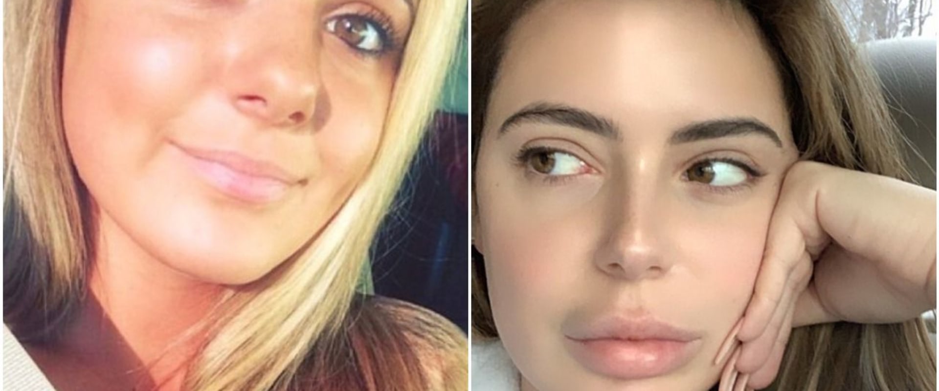 Dissolving Lip Fillers: A Comprehensive Guide